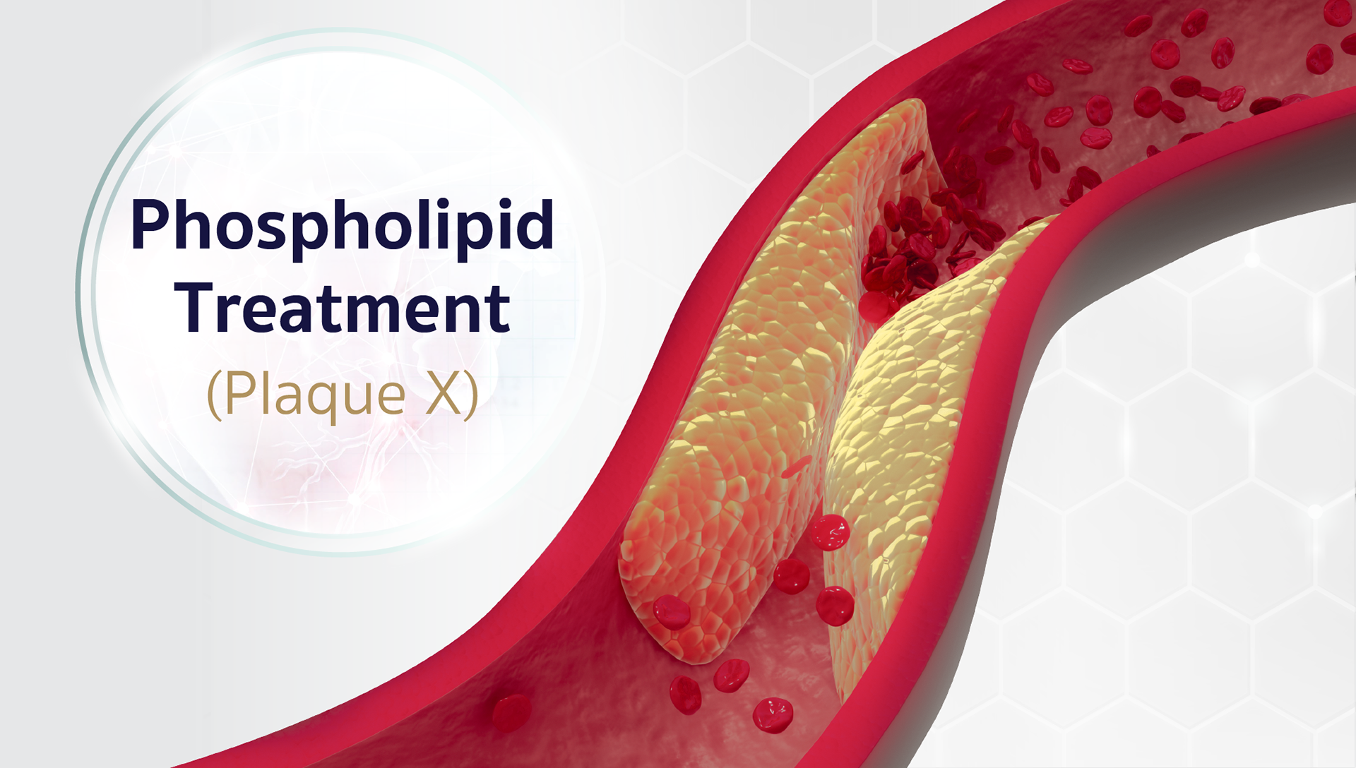 Phospholipid Treatment